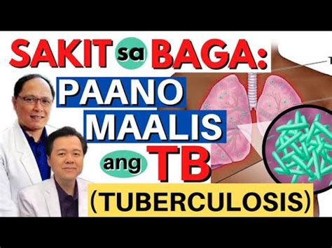 Sakit Sa Baga Paano Maalis Ang Tb Tuberculosis Payo Ni Doc Willie