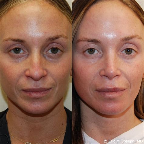 Eric M Joseph MD Rhinoplasty Before After Septoplasty And Hump