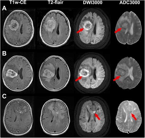 Frontiers Bright Edge Sign On High B Value Diffusion Weighted Imaging