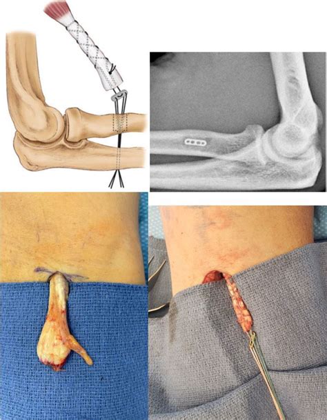 Distal Biceps Rupture Oklahoma County Distal Bicep Injuries Oklahoma
