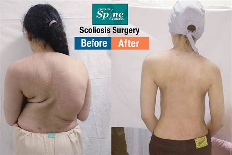 Scoliosis Surgery Gone Wrong