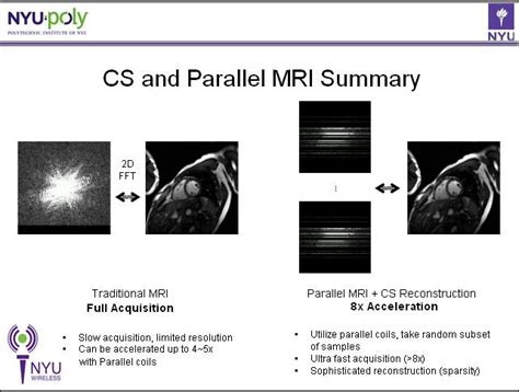 nuit blanche high speed compressed sensing reconstruction in dynamic parallel mri implementation