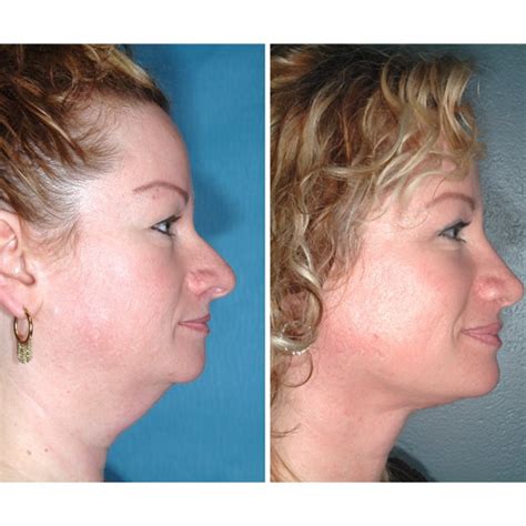 Lipo De Papada Chez Clinique