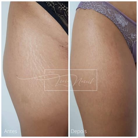 10 Natural Ways To Reduce And Prevent Pregnancy Stretch Marks Artofit