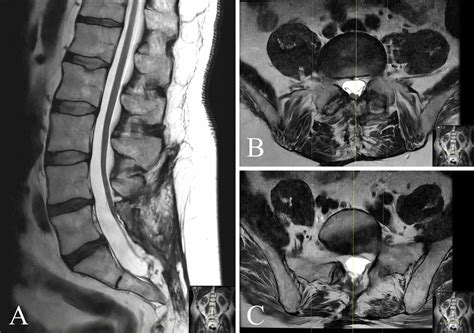 Spinal Column Shortening With Single Stage Prone Lateral Vertebral
