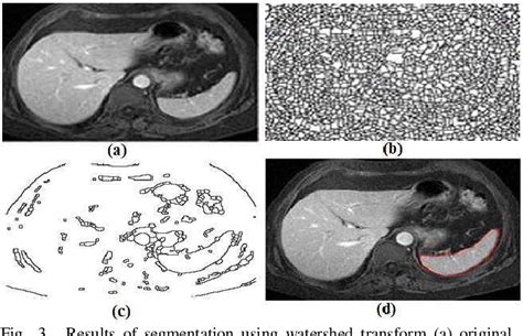 figure 3 from automatic spleen segmentation in mri images using a combined neural network and