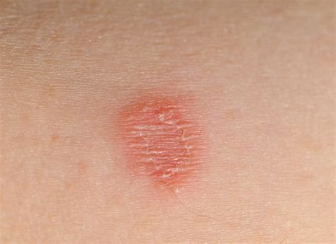 Tinea corporis o que é sintomas e tratamento Clínica Dra Juliana Toma