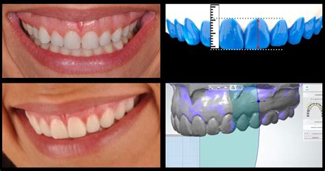 Diseño digital de sonrisa Clínica Blasi