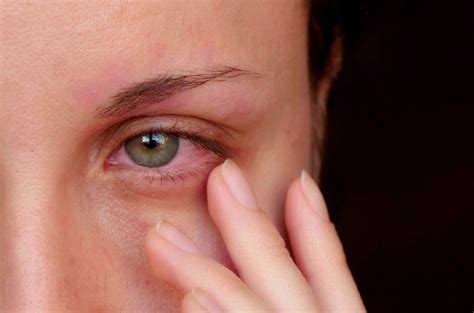 Bindehautentzündung Konjunktivitis Heilpraxis