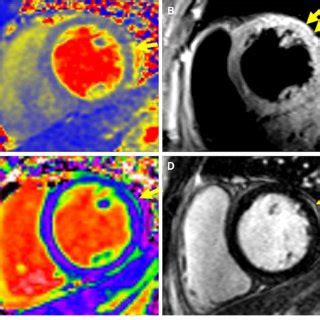 Cardiac MRI Of An MIS C Patient With Evidence Of Myocarditis A T2 Map
