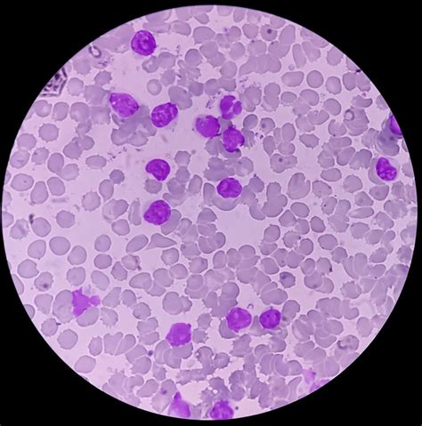 Aggressive T Cell Leukemias Images Stock Photos D Objects