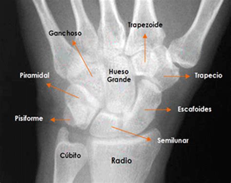 Medical Dentix La importancia de la radiografía carpal