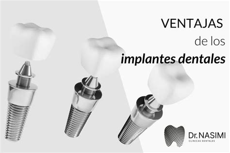 Ventajas De Los Implantes Dentales Clinicas Dr Nasimi