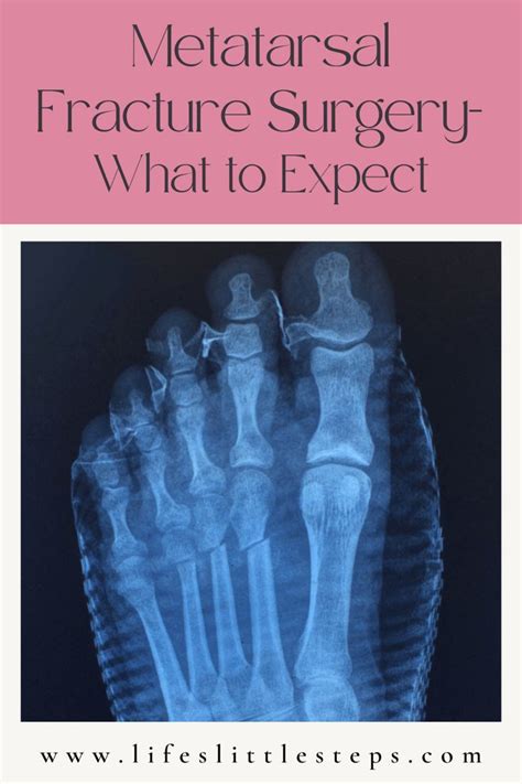 Metatarsal Fractures Xray Metatarsal Fracture Avulsion Fracture Jones