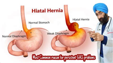 What Is Hiatus Hernia Symptoms Treatment Explained In Hindi Dr