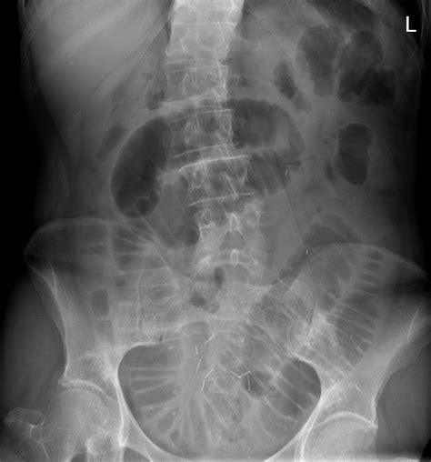 Small Bowel Obstruction Adhesions Radiology At St Vincent S