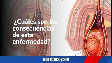 Qu Es La Epididimitis Y Cu Les Son Sus Consecuencias Youtube