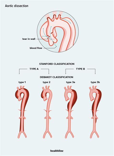Dissection Of The Aorta Types Symptoms Treatment