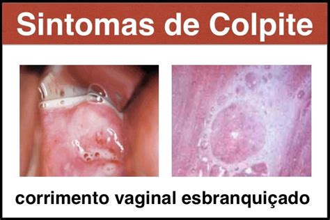 Sintomas Da Colpite Tua Sa De