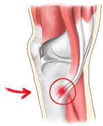 Pes Anserine Knee Tendon Bursitis Physiotherapy Simply Align Rehab