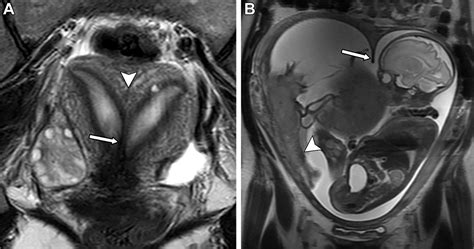 Müllerian Duct Anomalies Role in Fertility and Pregnancy RadioGraphics
