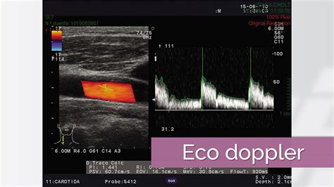 Qué es el Eco Doppler y cómo se realiza IDACA