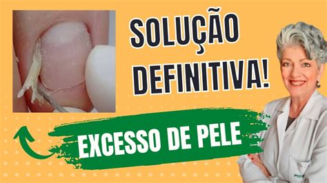 Você Tem EXCESSO DE PELE Saiba o Que Fazer YouTube