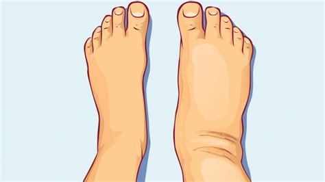 Fibromiyalji Hastalığı Nedir Belirtileri Nelerdir