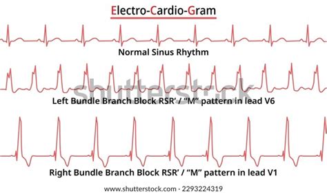 Set Ecg Common Abnormalities Left Bundle Stock Vector Royalty Free