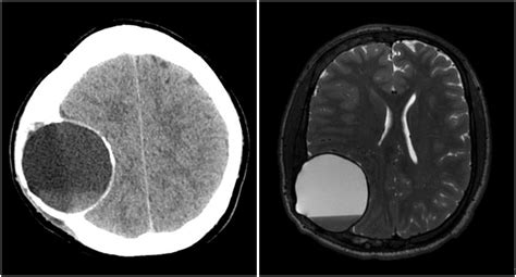Aneurysmal Bone Cyst Mri