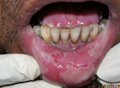 Ulcers By Oral Pemphigus Vulgaris
