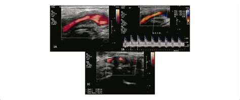 Transient Perivascular Inflammation Of The Carotid Artery TIPIC