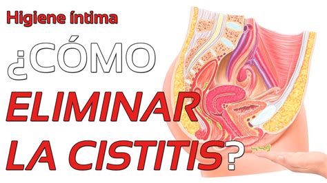 Por Qu Se Produce La Cistitis Formas De Eliminar La Infecci N Youtube