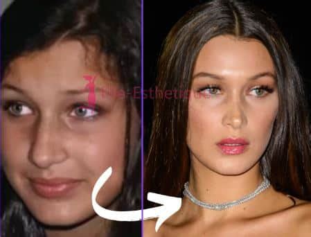 Bella Hadid Avant Après Chirurgie Vaut elle le Coup