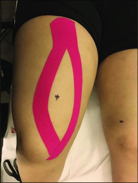 The KT Application Technique On VMO KT Indicates Kinesio Taping VMO