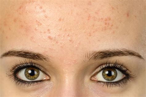 Tips Cantik Menghilangkan Bruntusan Di Jidat Secara Efektif