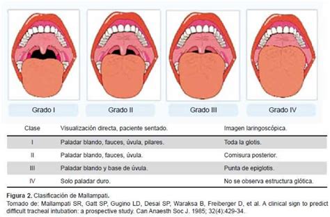 Hipertrofia De Amígdalas Grau 3 BRAINCP