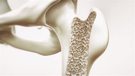 Osteoporose Symptome früh erkennen und behandeln NDR de Fernsehen