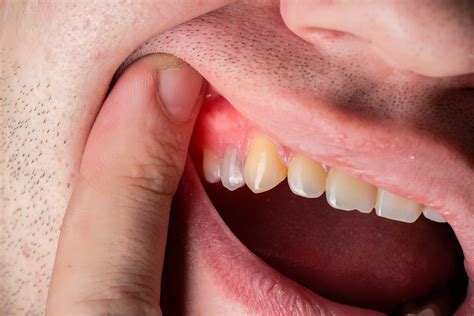 Periodontitis Causas Y Tratamiento Cl Nica Dental El Pilar