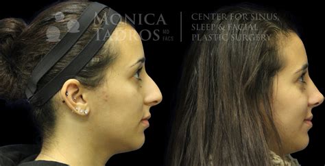 Rhinoplasty 36 Dr Monica Tadros