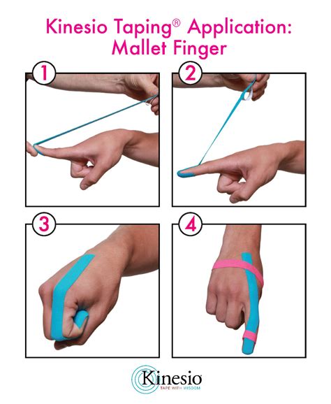 Kinesio Taping Application Mallet Finger Kinesio Tape