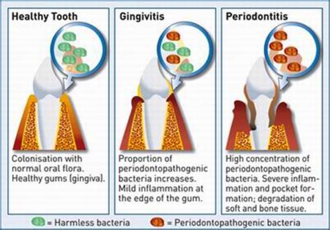 Clasificaci N De Las Enfermedades Y Condiciones Periodontales 29890