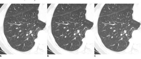 figure 1 from validation of deep learning image reconstruction for low dose chest computed