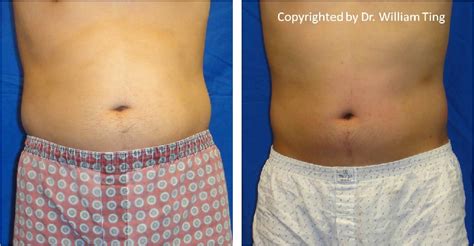 Tumescent Liposuction San Ramon California Dermatology