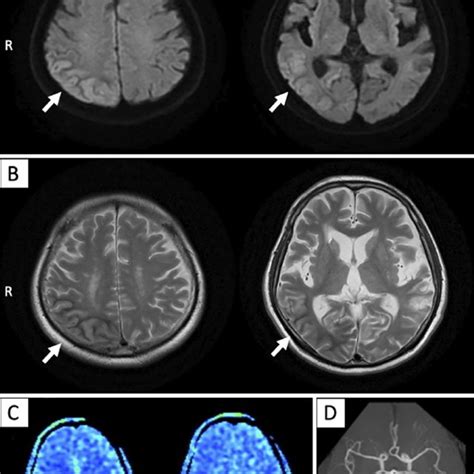 Figure1 Magnetic Resonance Imaging Findings At Admission A