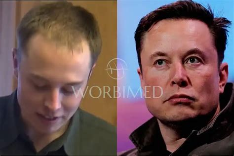 Elon Musk Hair Transplant L Before And After