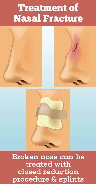 This Is The Treatment Of A Nasal Fracture MEDizzy