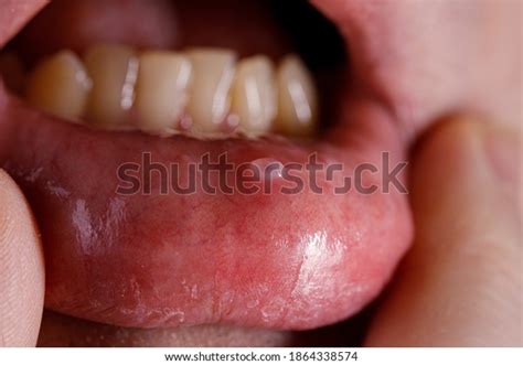 Clear Bump Inside Lip Cause