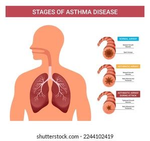 Asthma Infographics Vector Stages Human Asthma Stock Vector Royalty
