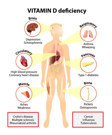 Vitamin D Deficiency Signs And Symptoms Nhs